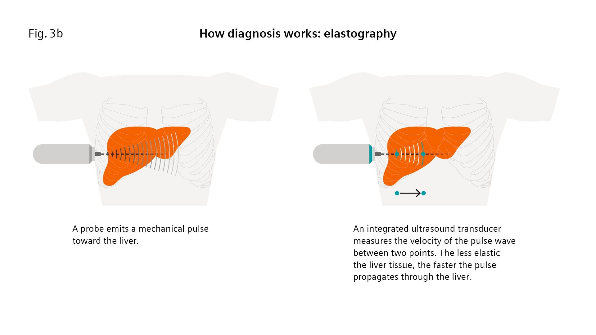 Liver fibrosis: Patients can be at risk of death even without ...