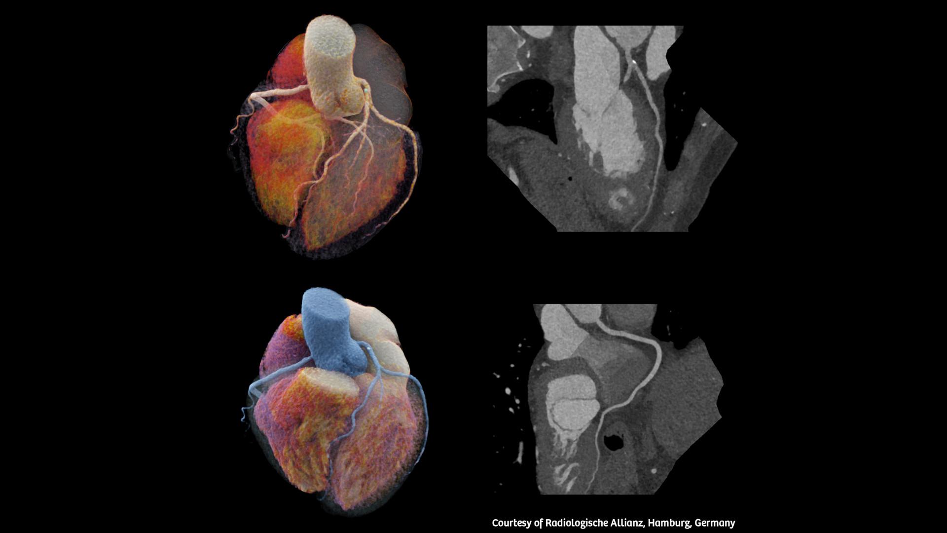 Siemens Healthineers broadens access to high-end Dual Source CT technology