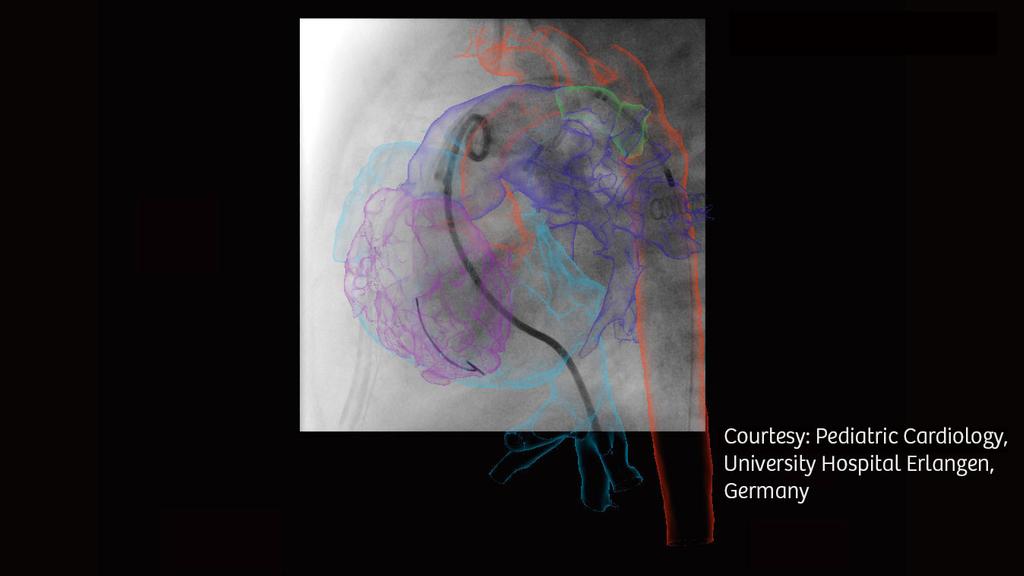 A Clear View Inside Tiny Hearts