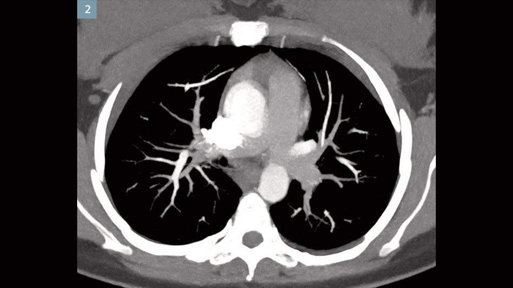 Pulmonary Embolism Diagnosis in Pregnancy: How Bicêtre Hospital ...