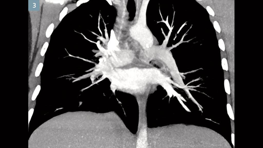 Pulmonary Embolism Diagnosis in Pregnancy: How Bicêtre Hospital ...