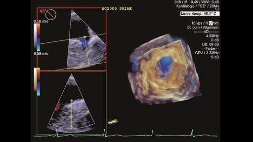 Imaging Support from 3D TEE in Left Atrial Appendage Closures