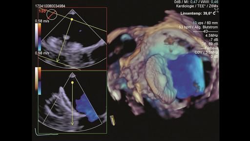 Imaging Support from 3D TEE in Left Atrial Appendage Closures
