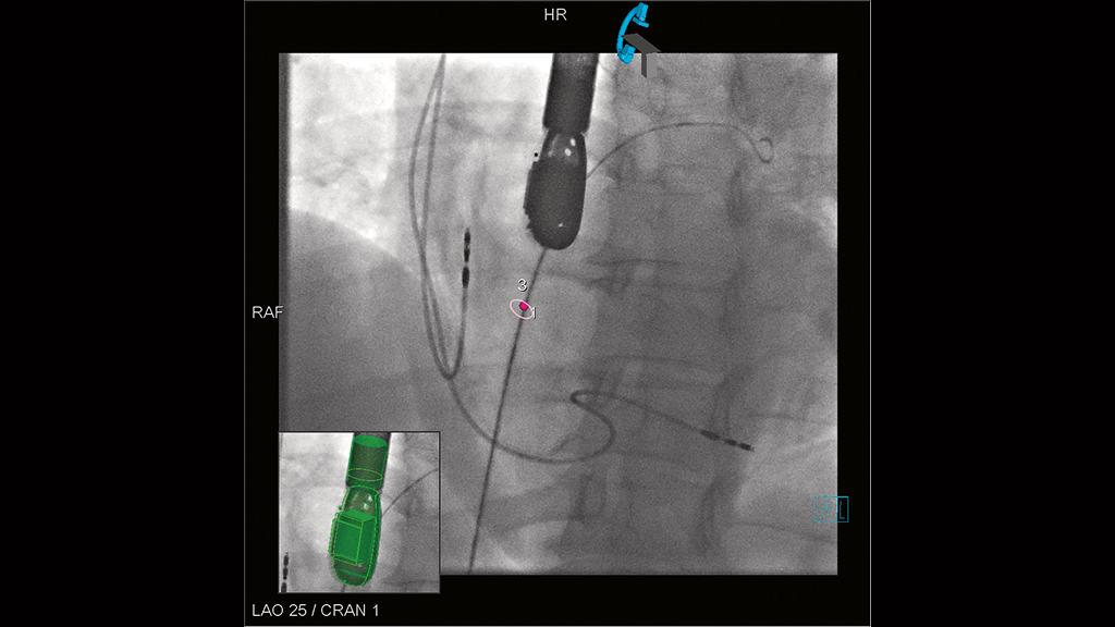 Image Fusion Applications: Precision Medicine for Structural Heart Diseases