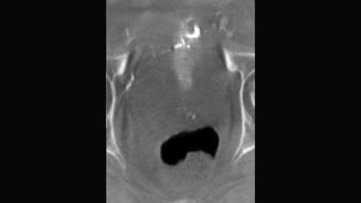 Prostatic Artery Embolization is Here to Stay