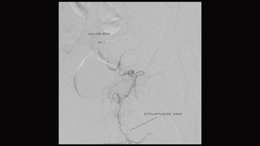 Prostatic Artery Embolization is Here to Stay