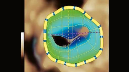 Percutaneous Lotus Valve Implantation in a Severely Stenotic Mitral Valve