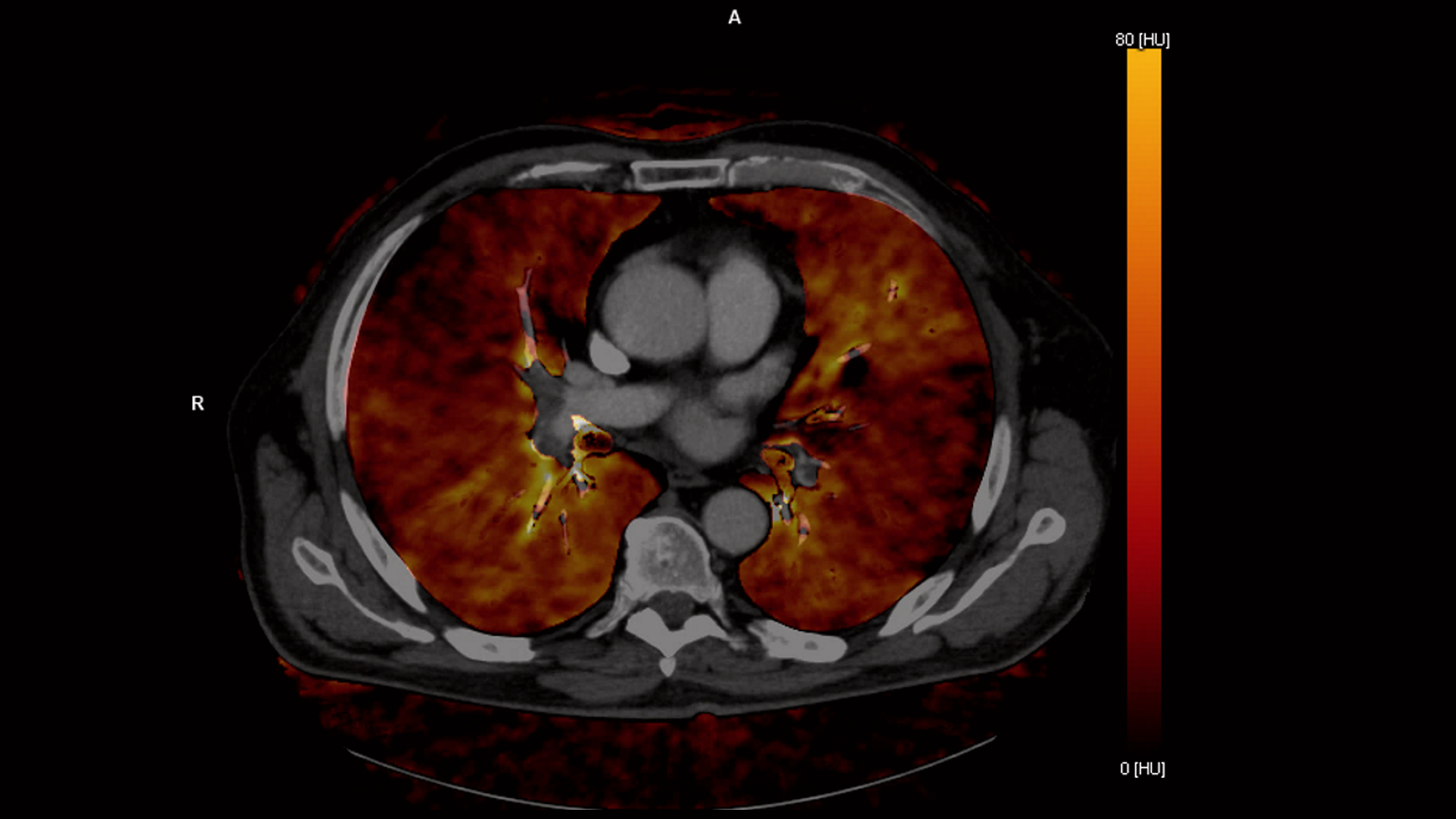 Siemens Healthineers markets new Somatom X.cite CT scanner with ...
