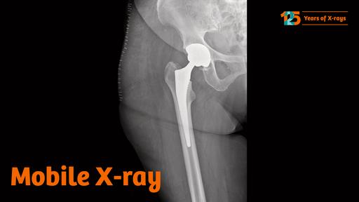 Mobile X-Ray