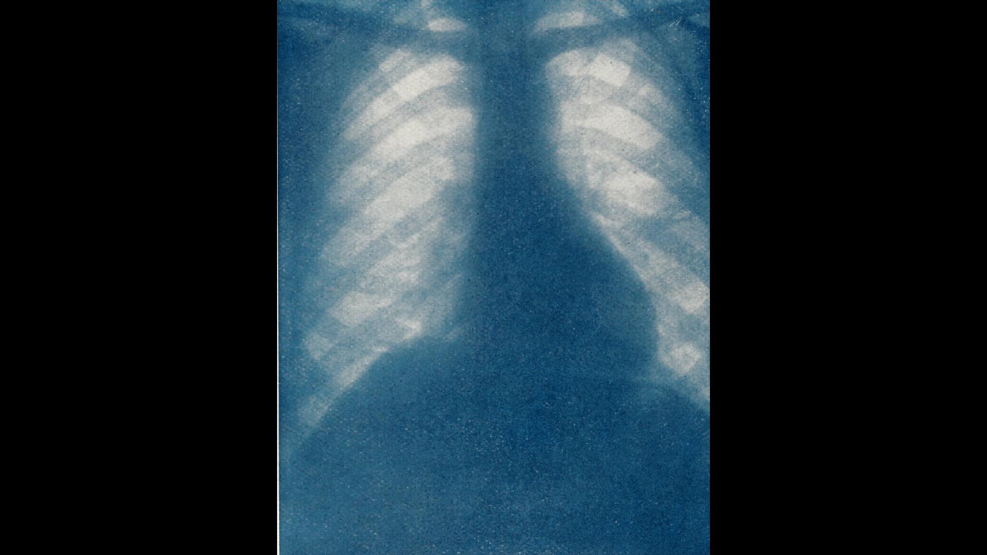 X-rays in Cardiology