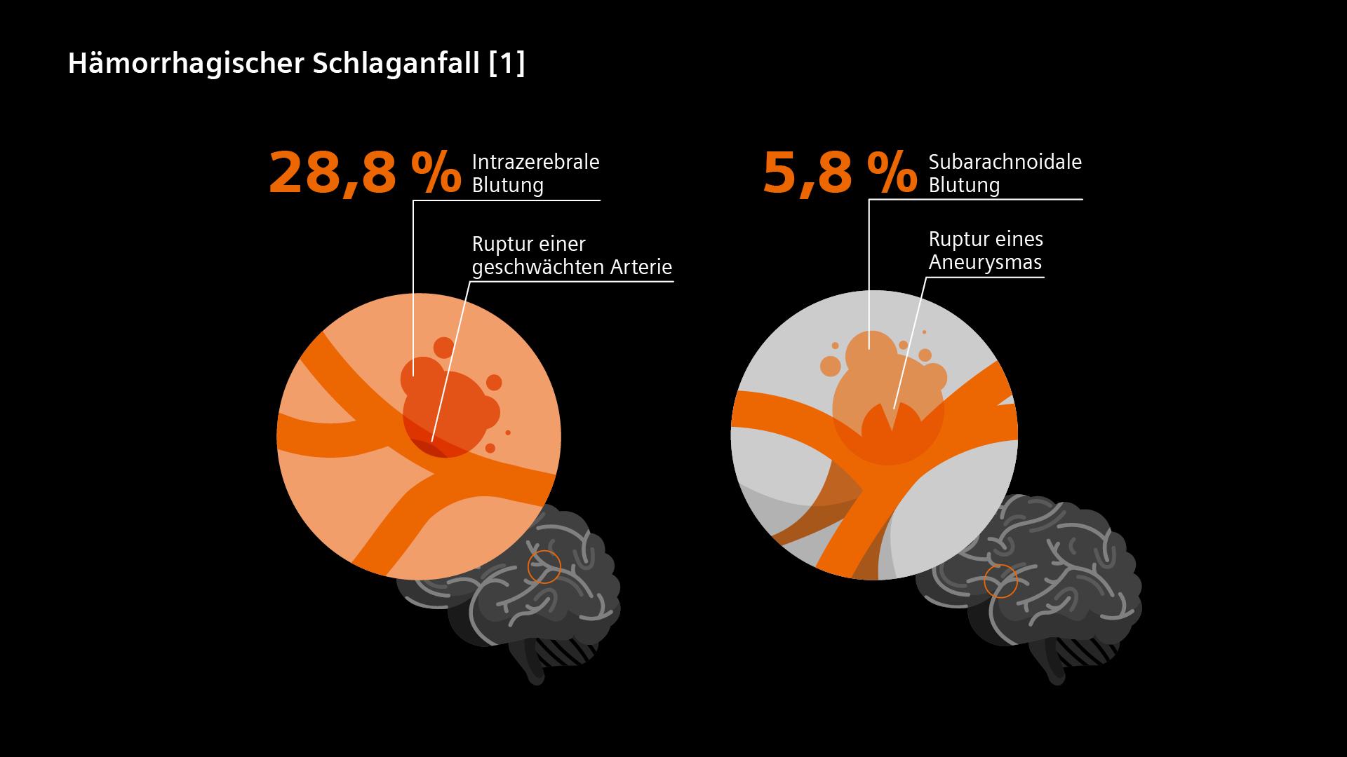Schlaganfall schnell und präzise behandeln