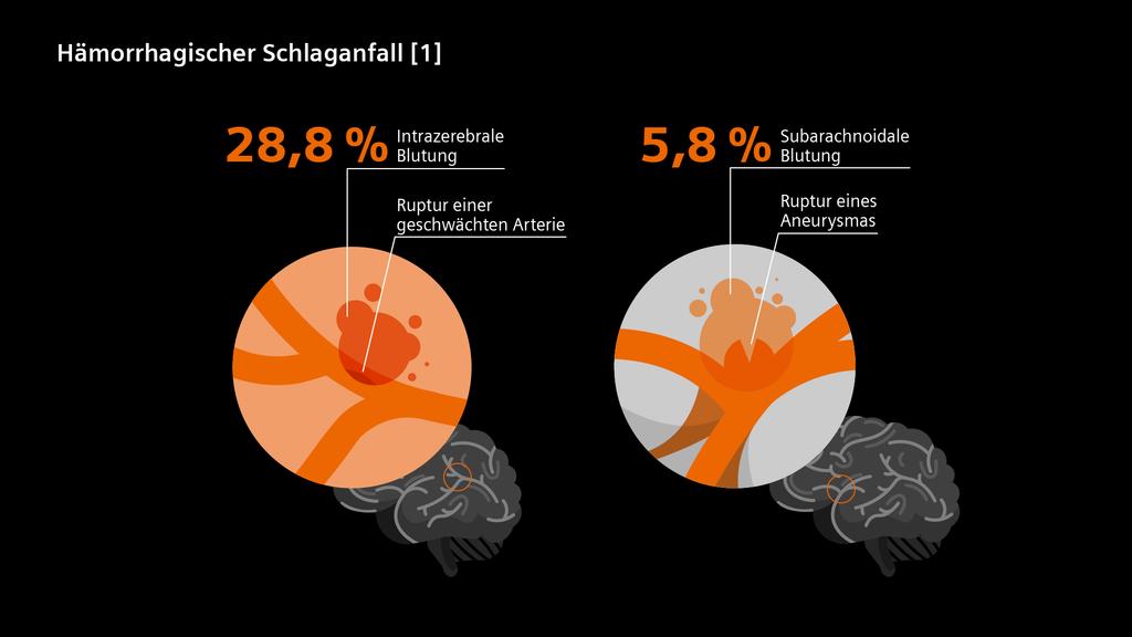 Schlaganfall schnell und präzise behandeln