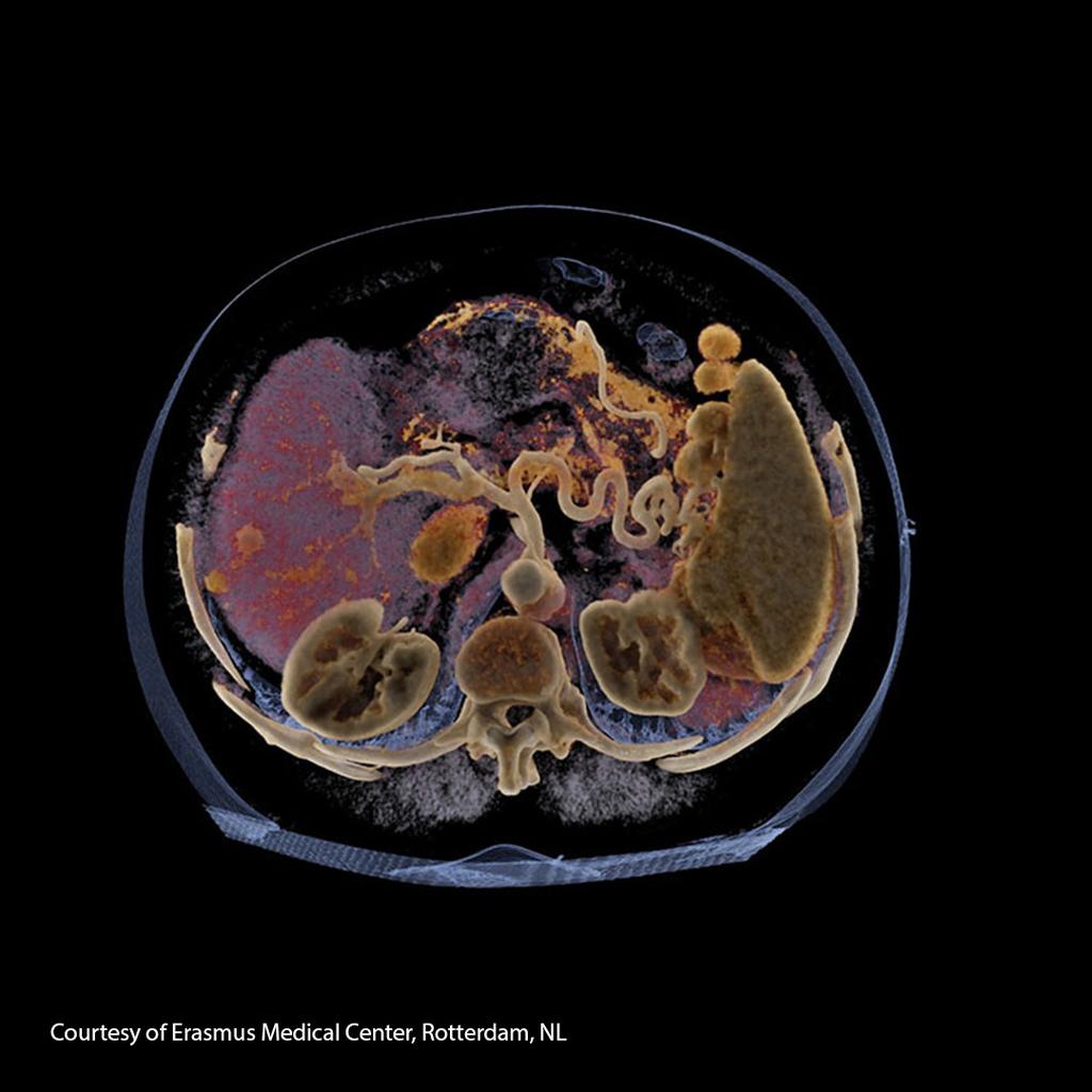 Liver Cancer: From diagnosis to personalized treatment