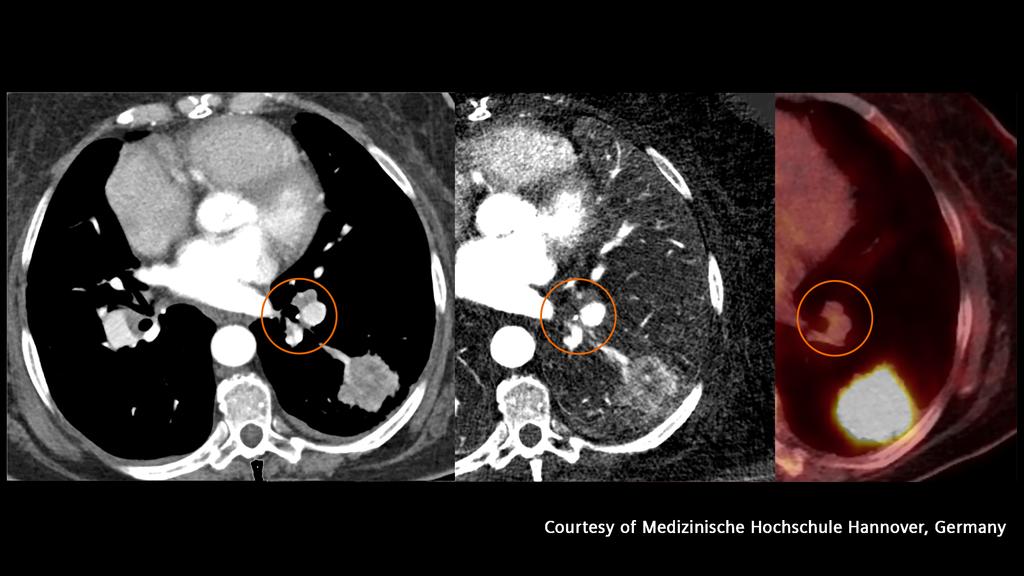 “Photon-counting CT will become the new standard in chest imaging”