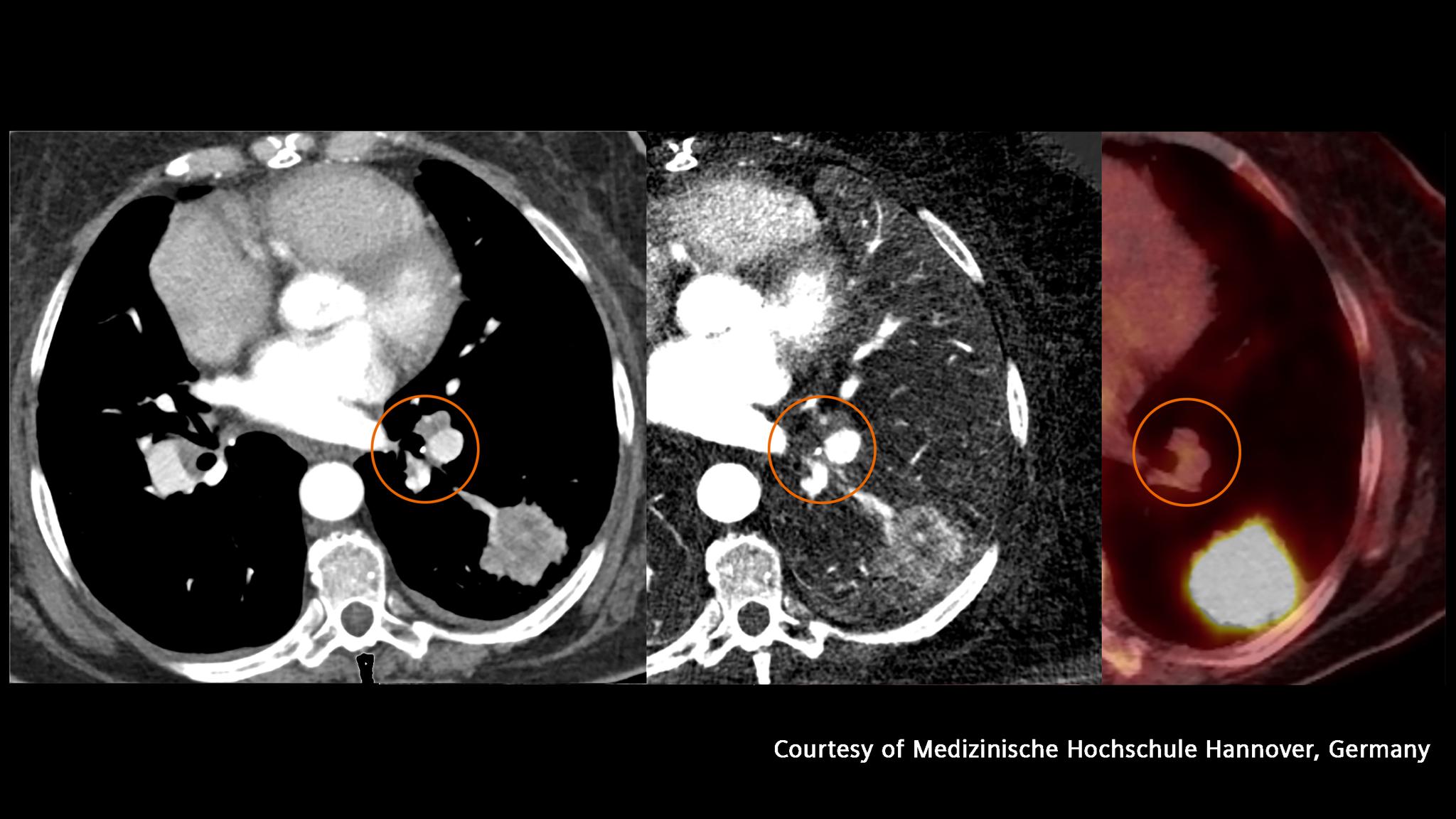 “photon Counting Ct Will Become The New Standard In Chest Imaging”