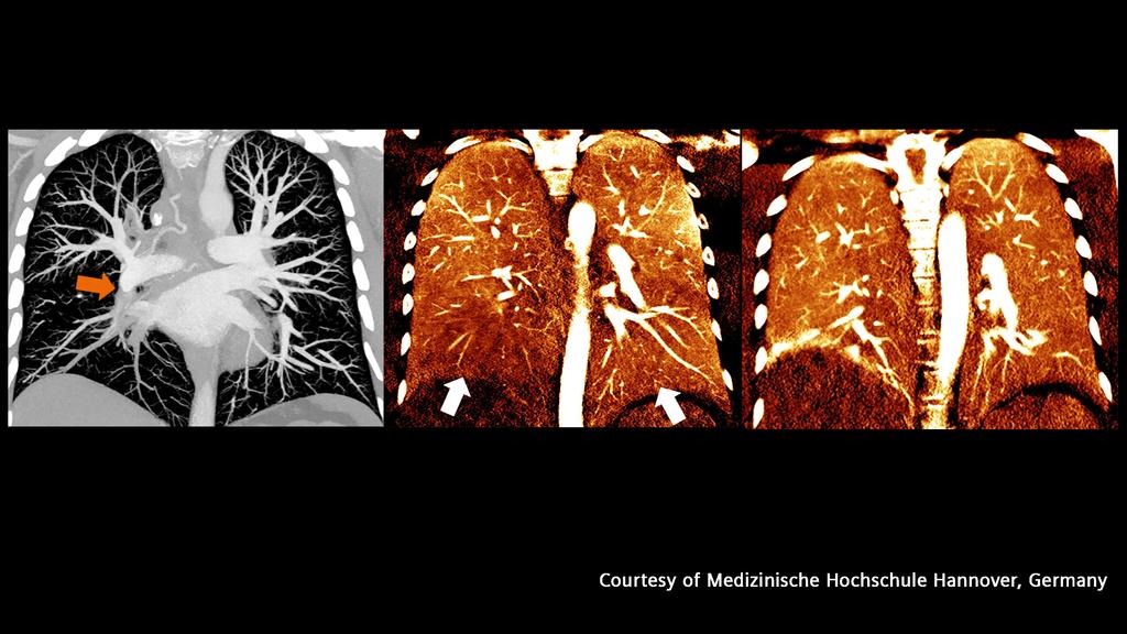“Photon-counting CT will become the new standard in chest imaging”