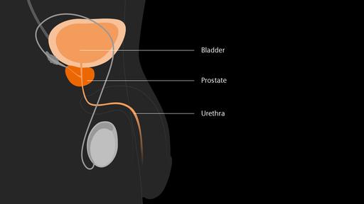 Prostate cancer: Facts, diagnosis, and treatment
