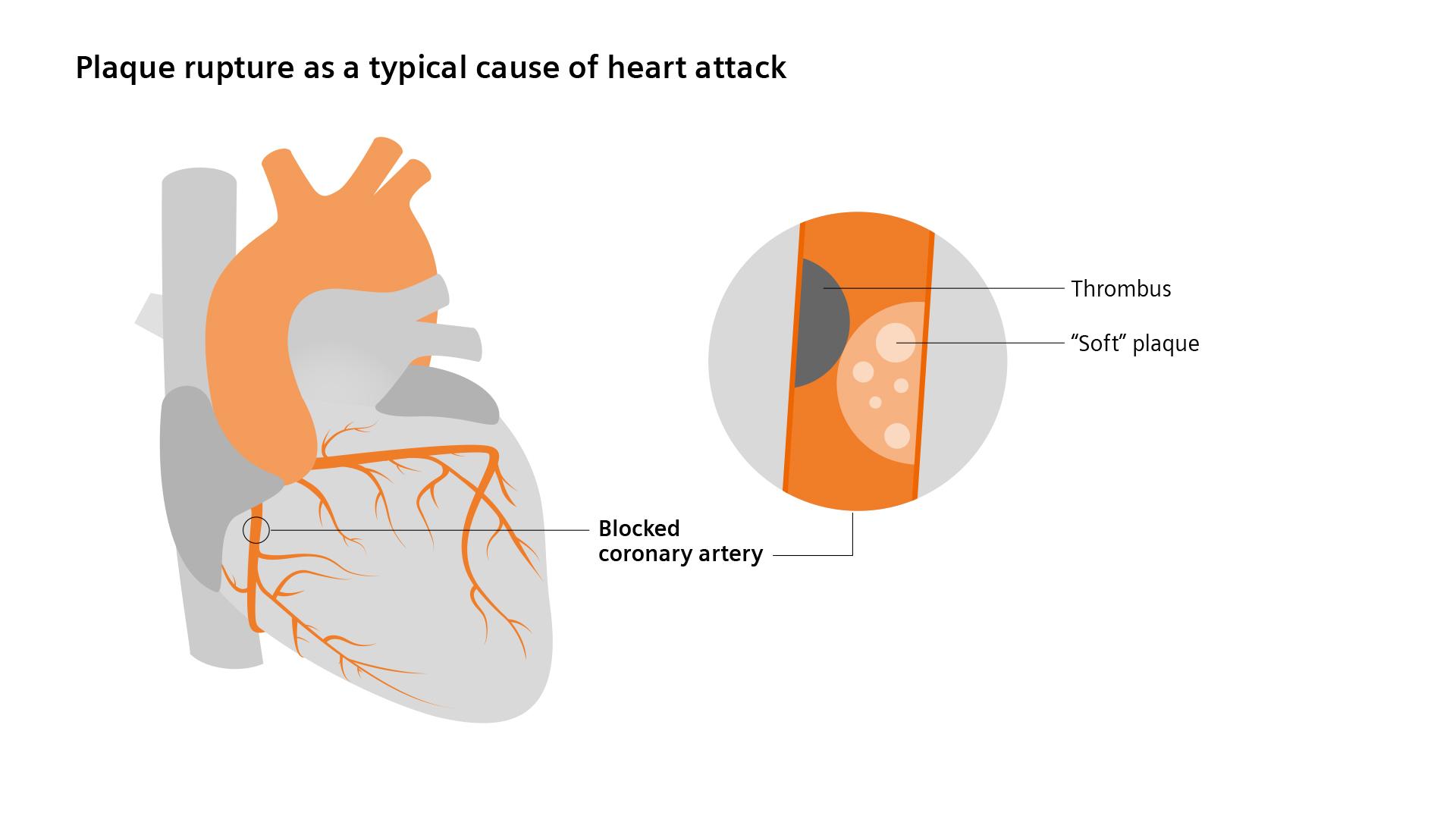 Women’s hearts give silent warnings
