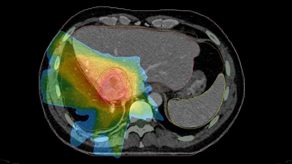 Liver Cancer From Diagnosis To Personalized Treatment