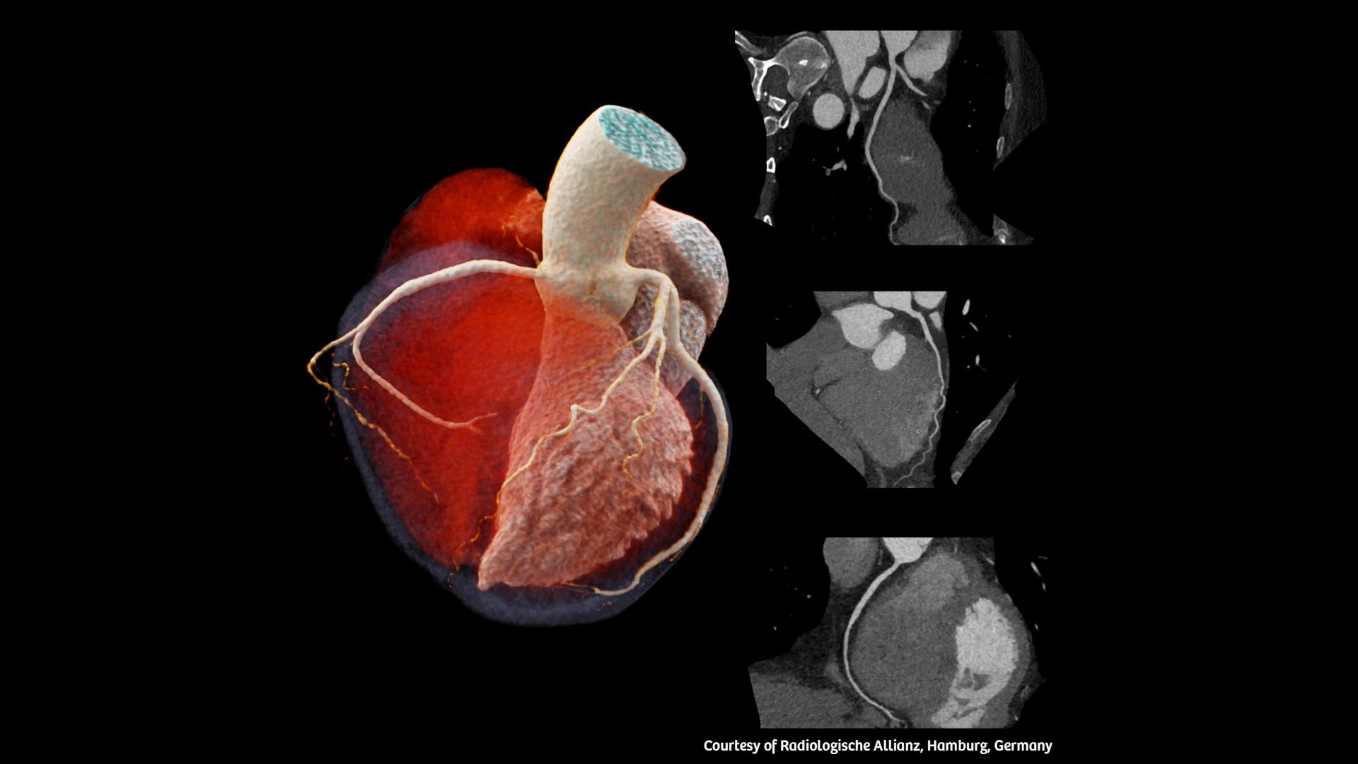 Siemens Healthineers broadens access to high-end Dual Source CT technology