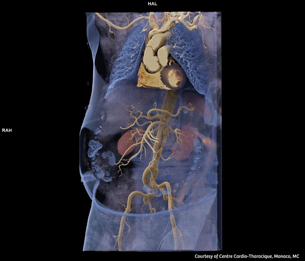 Photon-counting CT: quick and noninvasive scanning