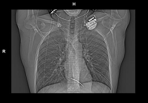 From a picture of health to sudden cardiac death