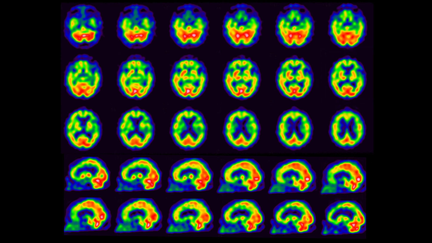 A review of nuclear neurology