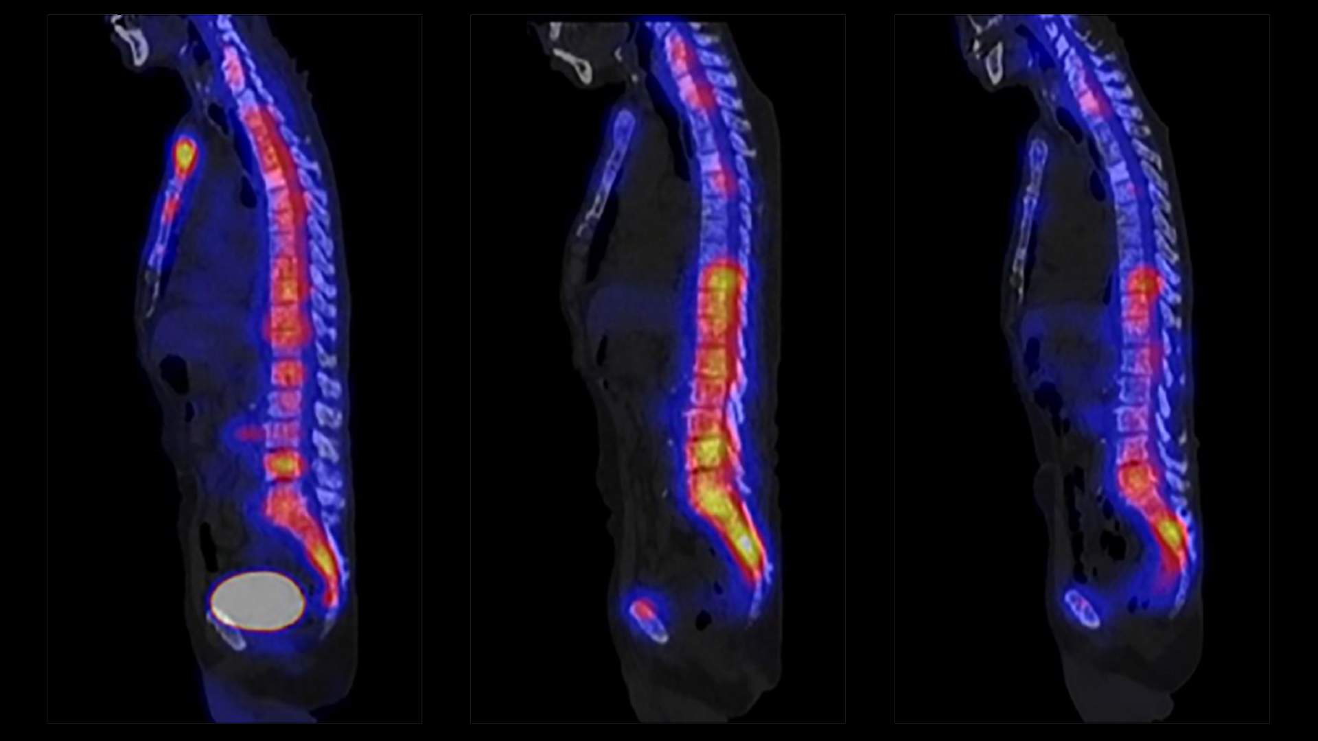 Theranostics: A new treatment for prostate cancer