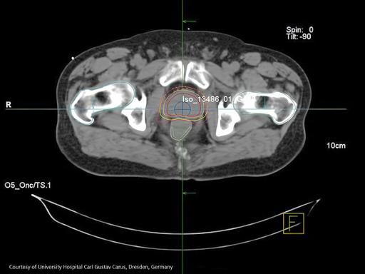 Prostate cancer: Facts, diagnosis, and treatment