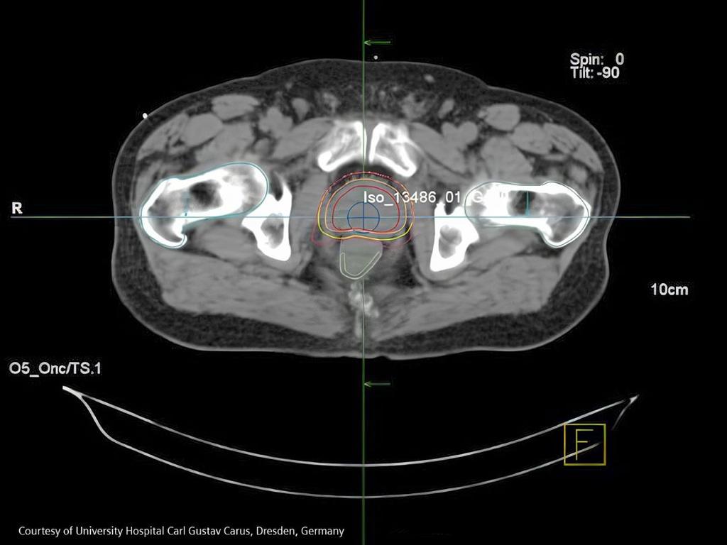Prostate cancer: Facts, diagnosis, and treatment