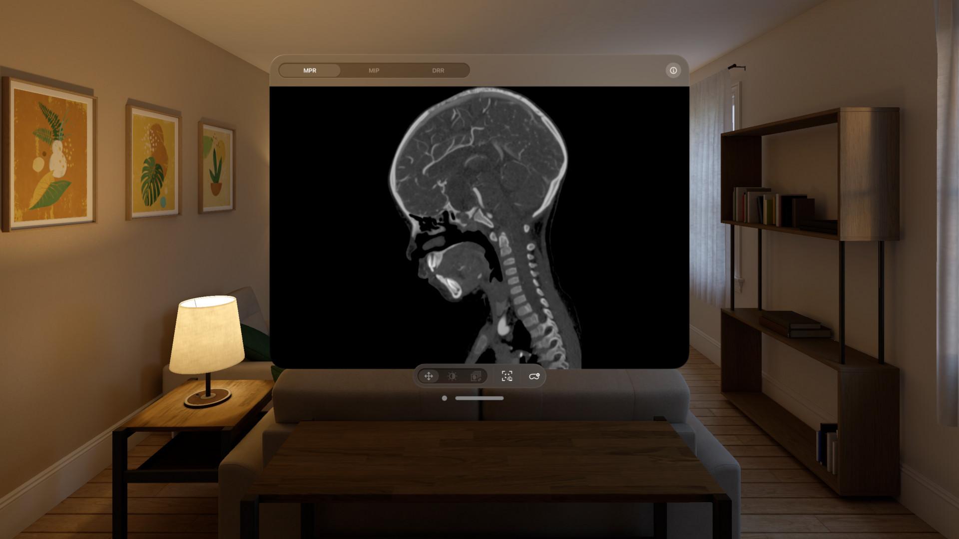 Siemens Healthineers launches Cinematic Reality app for Apple Vision Pro