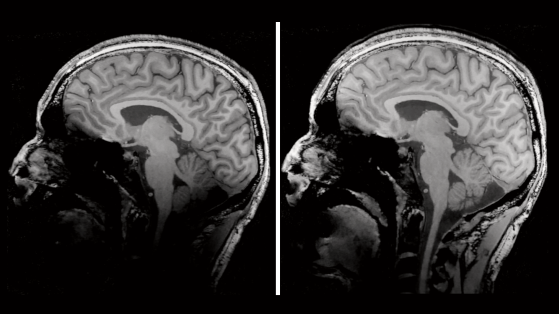 Siemens Healthineers presents two revolutionary high-end MRI scanners ...