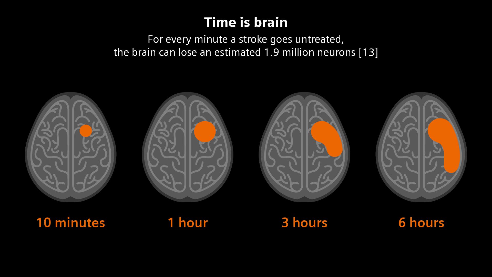 Tackling stroke with speed and precision