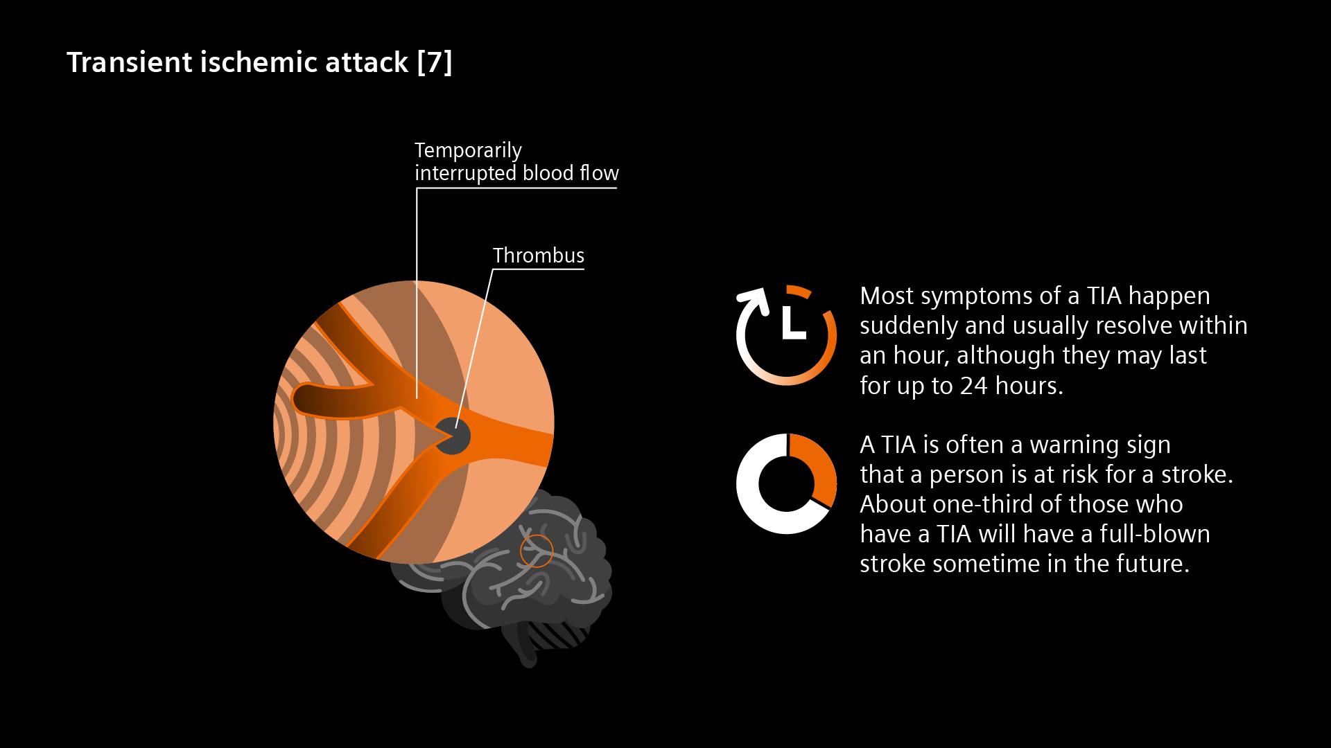 Tackling stroke with speed and precision