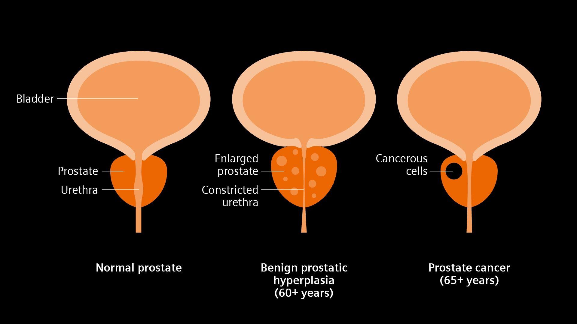 Prostate cancer: Facts, diagnosis, and treatment
