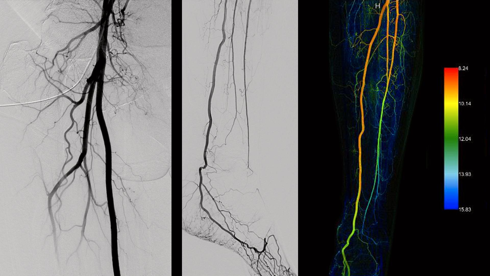 Siemens Healthineers introduces angiography system Artis icono ceiling ...