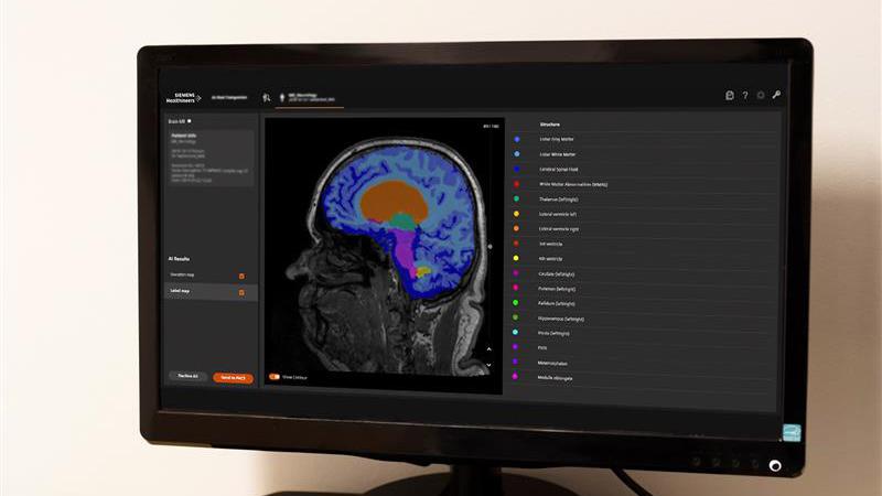 Artificial intelligence supports clinicians in reading brain images