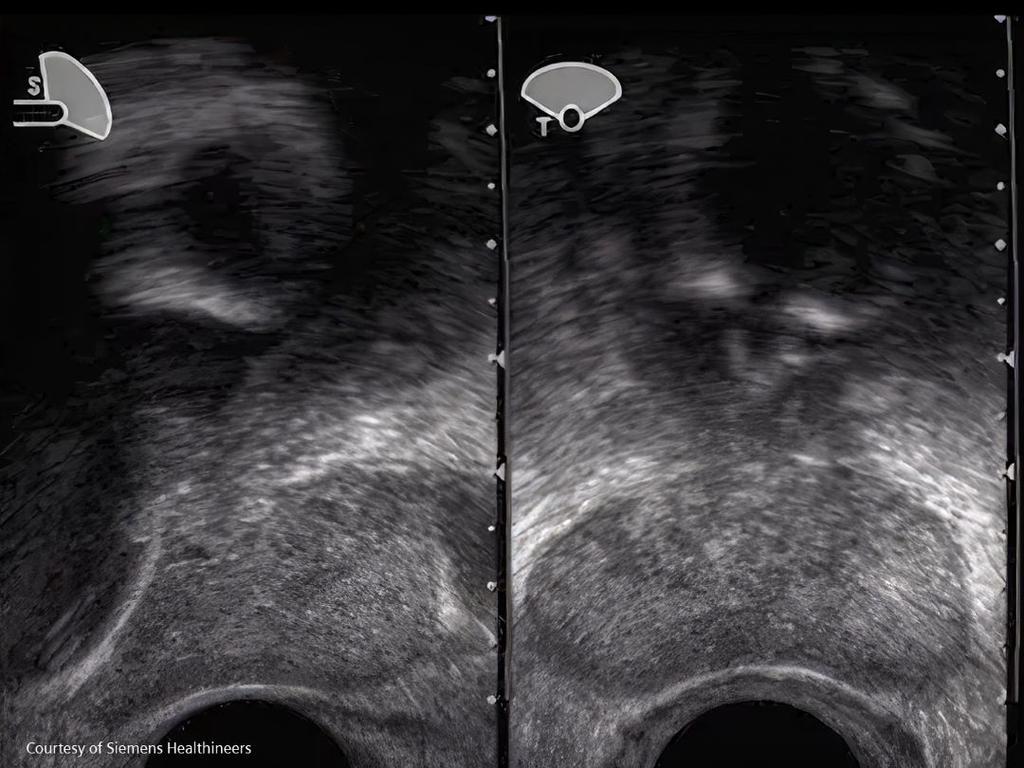 Prostate cancer: Facts, diagnosis, and treatment
