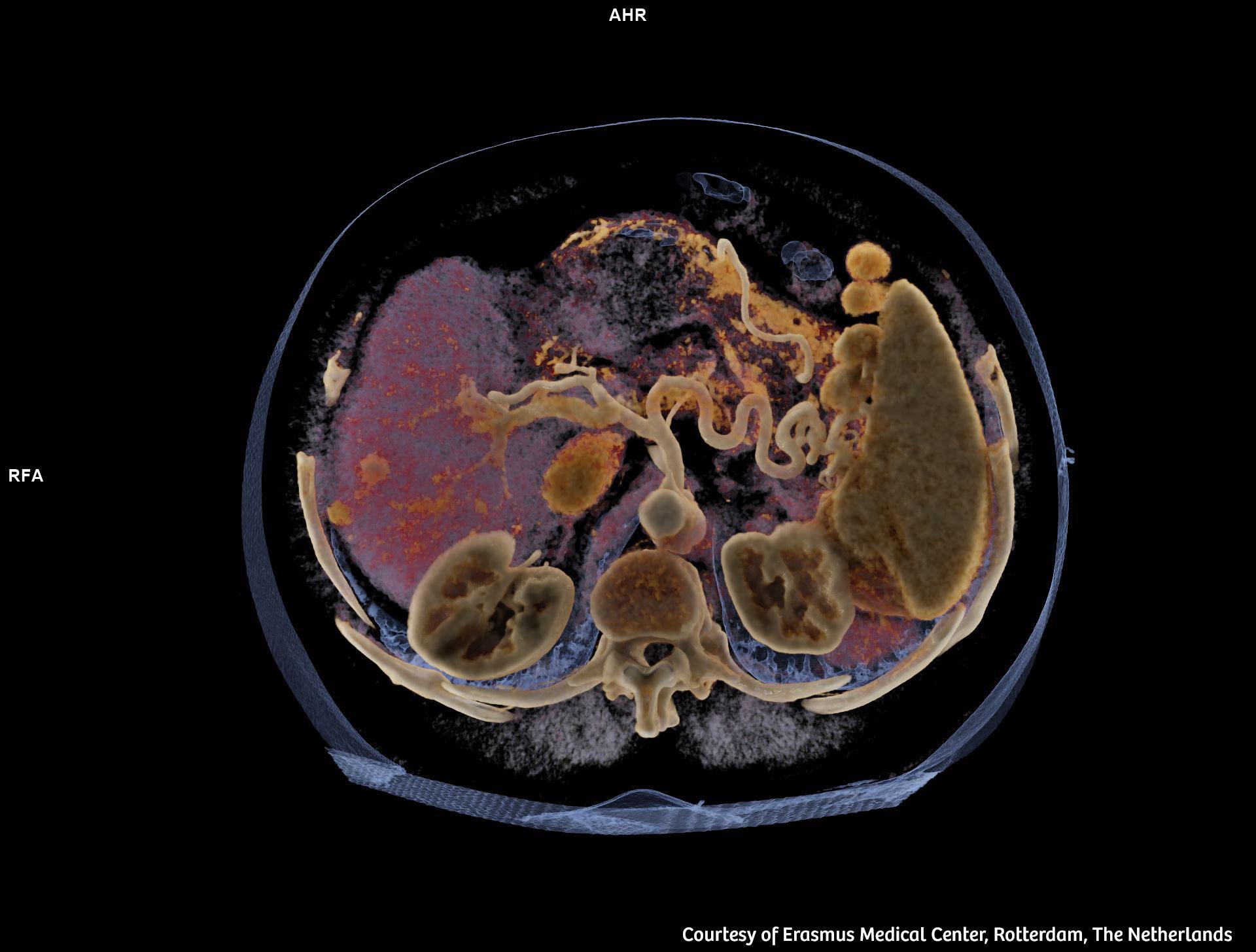 Photon-counting CT: quick and noninvasive scanning