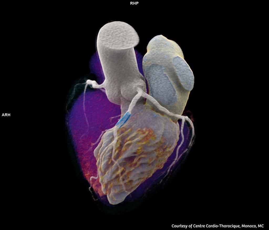 Photon-counting CT: quick and noninvasive scanning