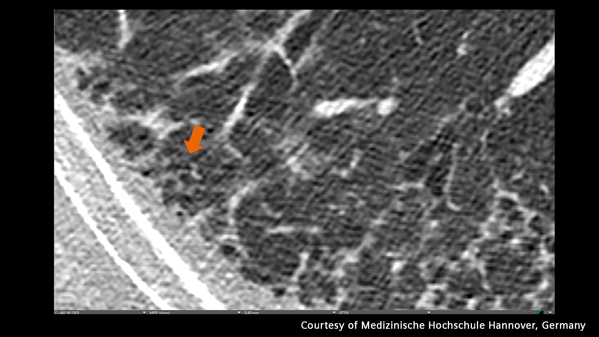 “Photon-counting CT will become the new standard in chest imaging”